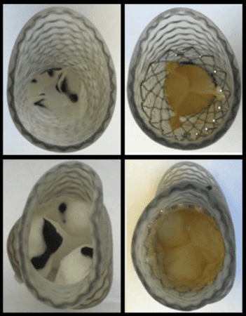 Assisting Cardiologists with 3D Printed Heart Valves - Proto3000